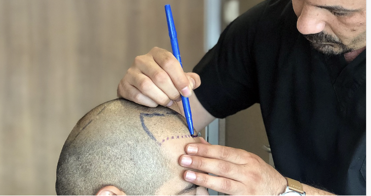 Our Hair Transplant Packages - Expirius.sg